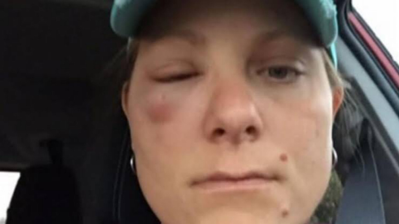 '90 Day Fiancé': Anna posts an old picture of her when she was bee stung